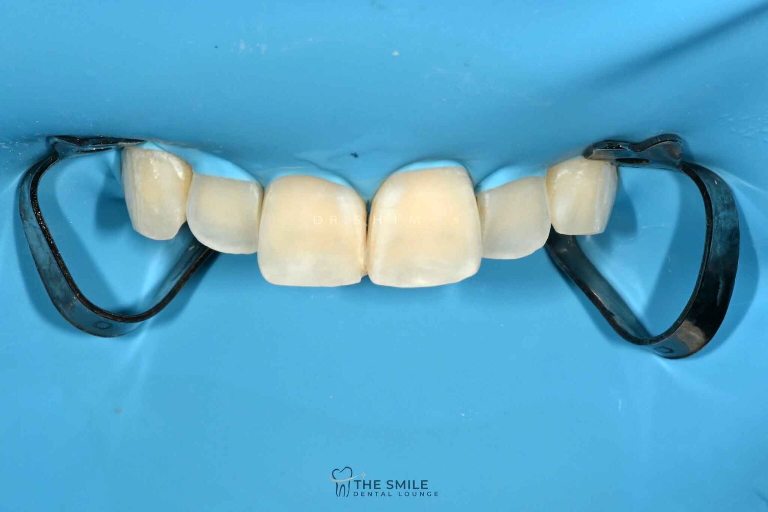 ICON Resin Infiltration - The Smile Dental Lounge -Dental Clinic Johor ...