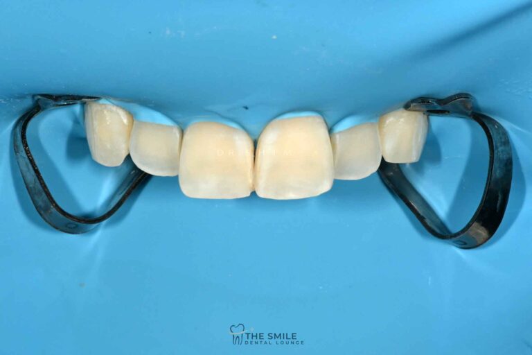 ICON Resin Infiltration - The Smile Dental Lounge -Dental Clinic Johor ...